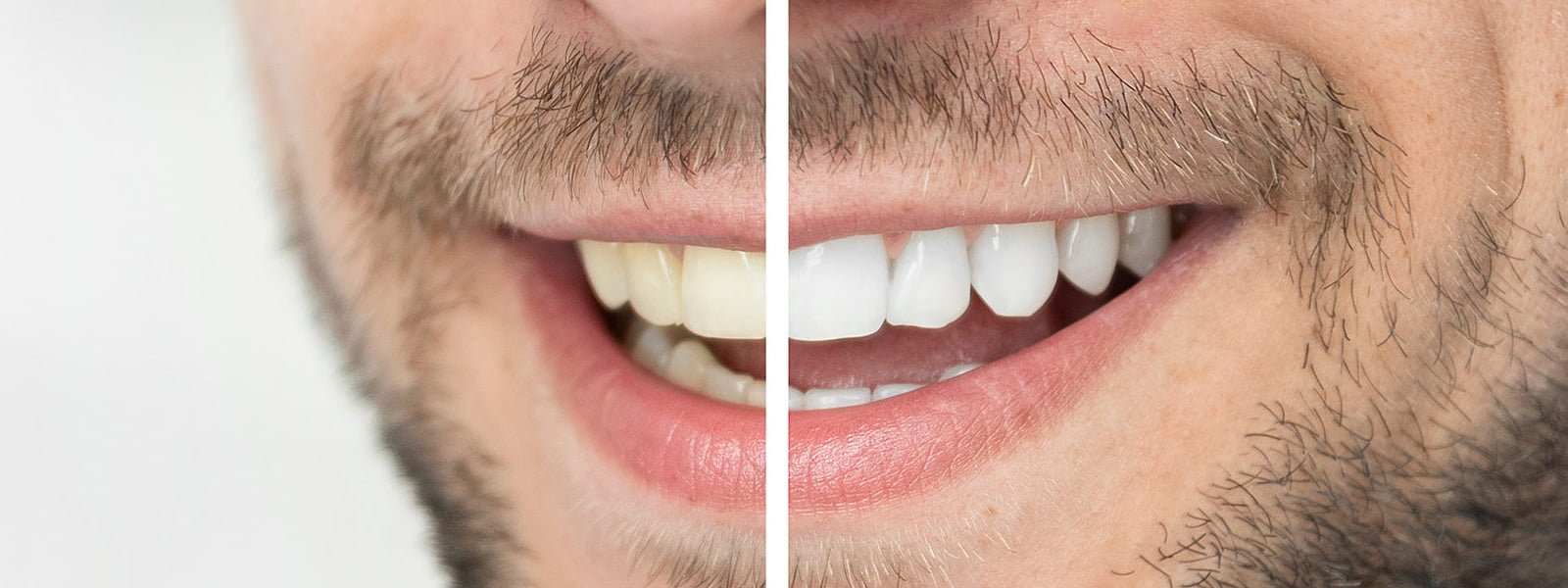 Blanchiment dentaire en Algérie - Dr Deramchi, Cabinet dentaire Alger